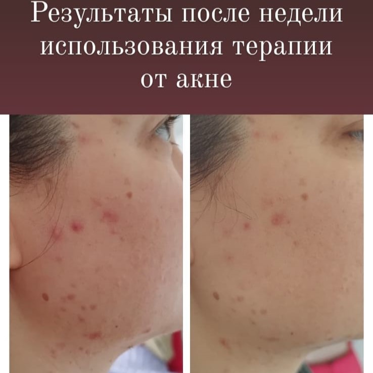 Набор Акне